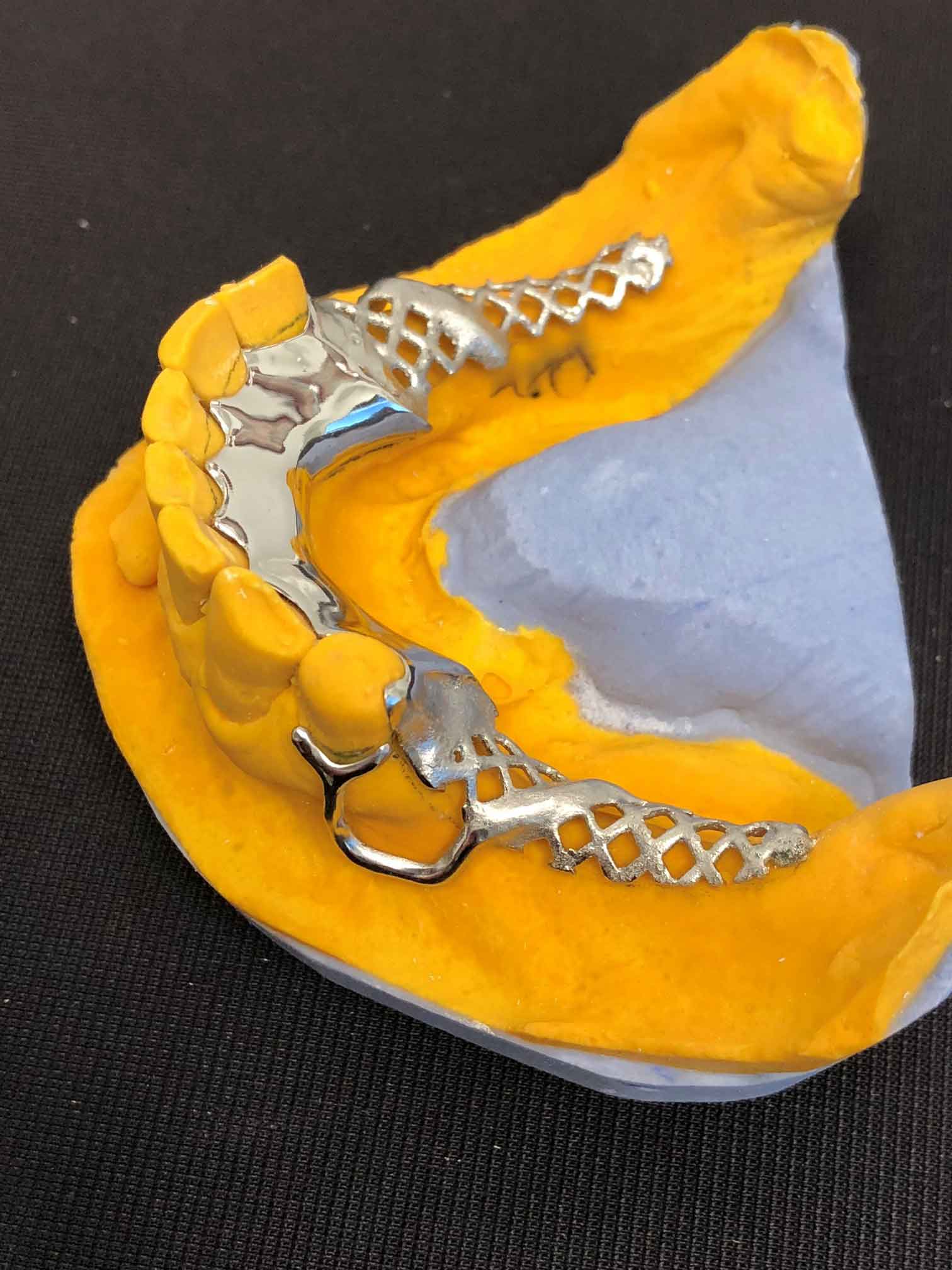 Cast Metal Partial Dentures | Amarillo, TX | Studio32 Dental Arts, LLC