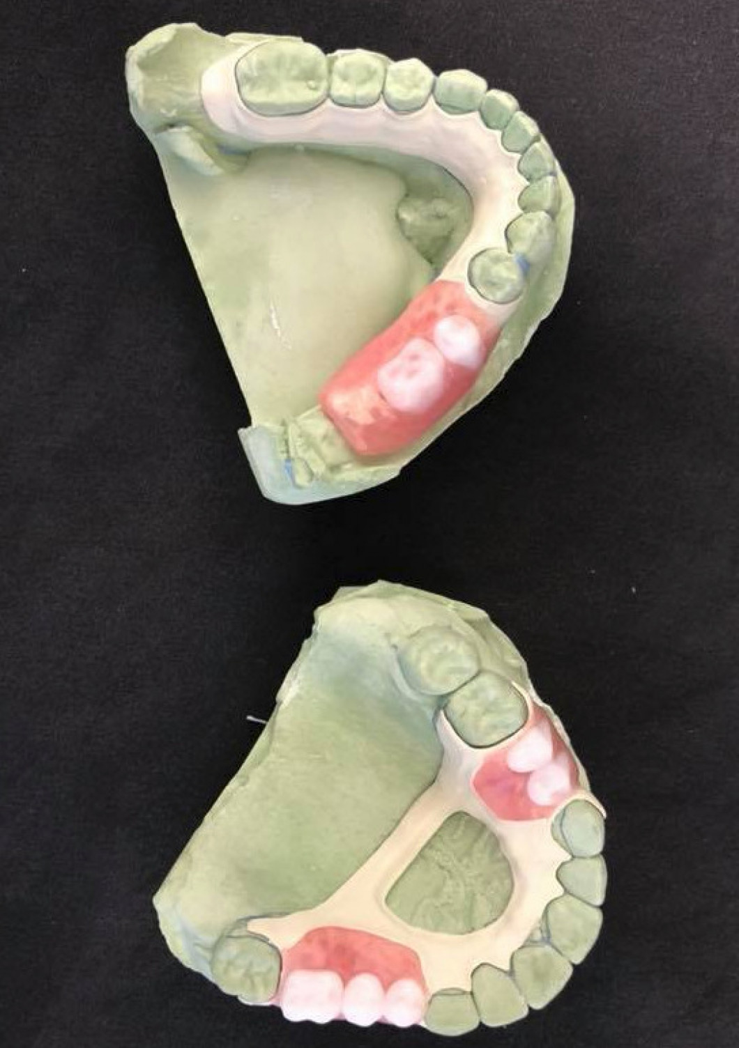 Metal-Free Partial Dentures | Amarillo, TX | Studio32 Dental Arts, LLC
